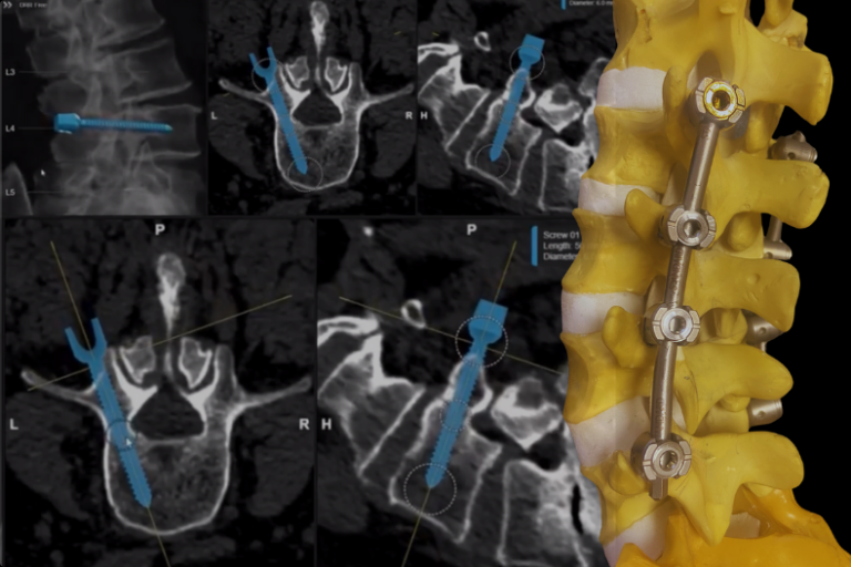 Omurga Kırığı Ameliyatı Olanların Bilmesi Gerekenler - Beyin ve Sinir ...