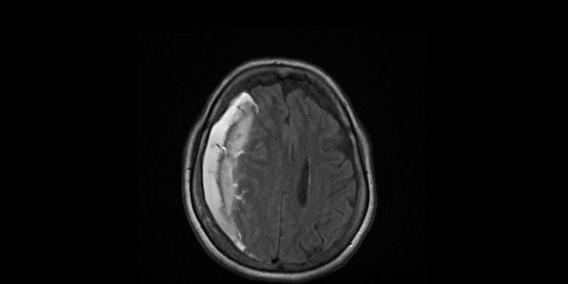 Kronik Subdural Kanama - Op. Dr. Caner Sarıkaya